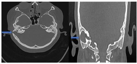 Sigmoid Sinus Sigmoid Sinus
