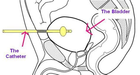 Suprapubic Catheter Female