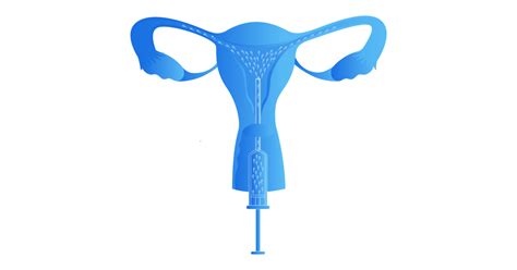 Artificial Insemination Types Process Costs And More