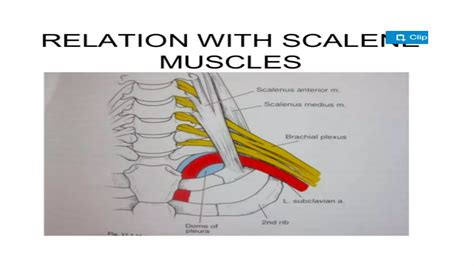 Radiation Induced Brachial Plexus Neuropathy Ppt