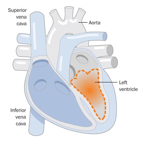 Clitoromegaly Steroids