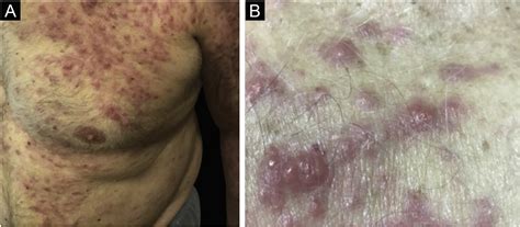 Scielo Brasil Dermatological Manifestations Of Hematologic Neoplasms