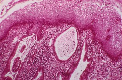 Cervical Cyst Light Micrograph Acheter Une Photo Science Photo Library