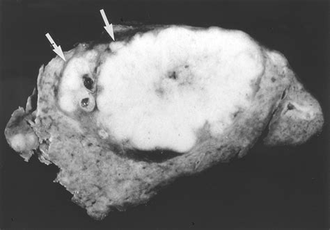 Cholangiocarcinoma Gross