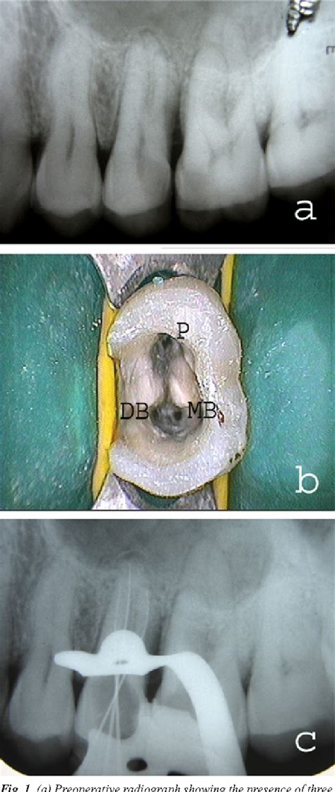 Maxillary Second Premolar