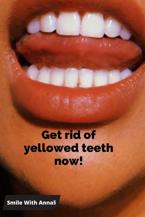 Get Rid Of Yellowed Teeth Teeth Health Tooth Ache Relief Oral Health
