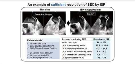 Example Of Sufficient Resolution Of Spontaneous Echo Contrast Sec Download Scientific Diagram