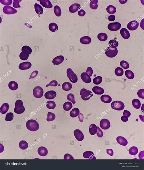 Basophilic Stippling Seen Peripheral Blood Smears Stock Illustration