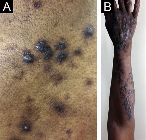 Prurigo Review Of Its Pathogenesis Diagnosis And Treatment Anais