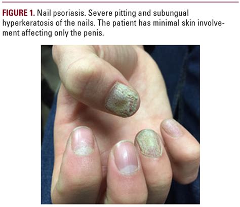 Psoriasis Nails Oil Spot