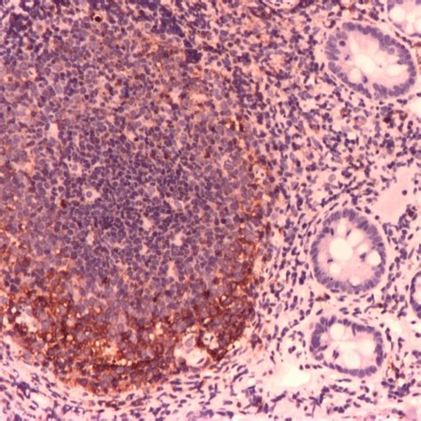 Polypoid Lesions In Terminal Ileum At Colonoscopy Download