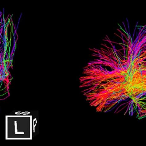 Example Of Anterior Corpus Callosum Section Tractography The Letters