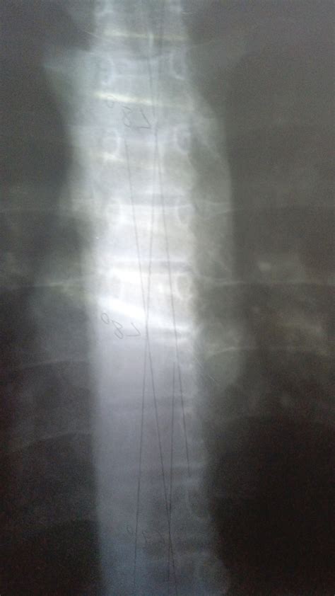 Сколиоз второй степени S образный При обследовании обнаружили S образный Medaboutme