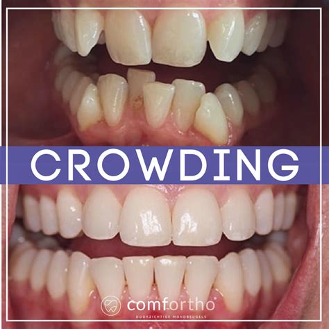 Invisalign Before And After Crowding