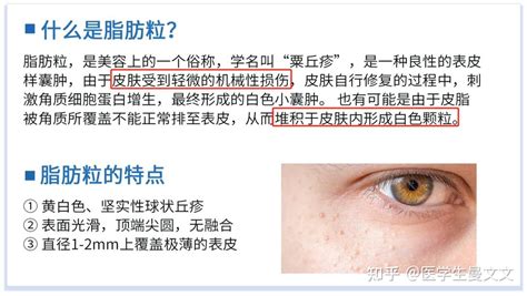 【长脂肪粒必看】眼周长满脂肪粒该怎么去？皮肤科医生科普正确去脂肪粒的方法！认准这3步，一个月轻松去除脂肪粒，恢复光滑眼周肌肤！
