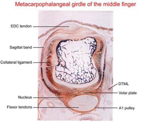 Sagittal Band Rupture Hand Orthobullets