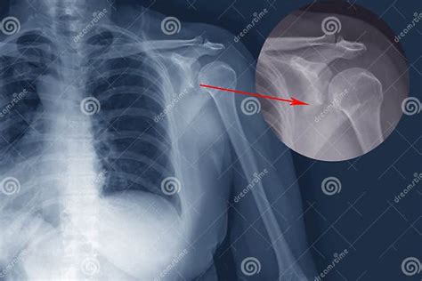 X Ray Shoulder Fracture Posterior Half Of Glenoid With Posterior Dislocation Of The Bone