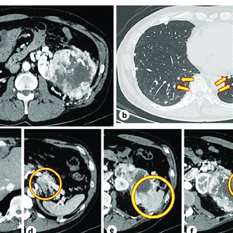 Contrast Enhanced Ct Just Before Deferred Cytoreductive Nephrectomy A Download Scientific