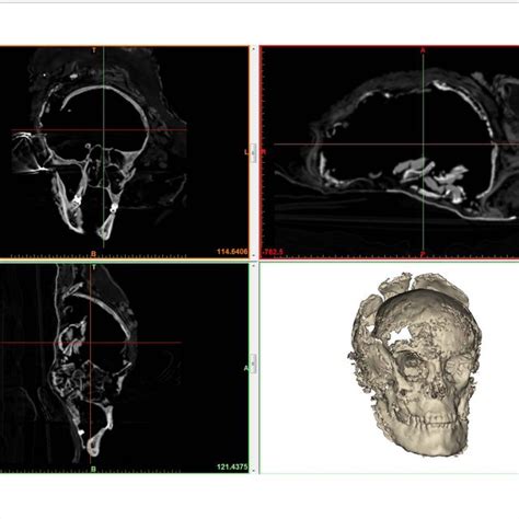 The Skrydstrup Woman As She Is Exhibited Today At The National Museum