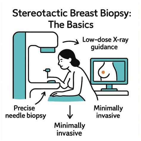 Stereotactic Breast Biopsy Guide What To Expect