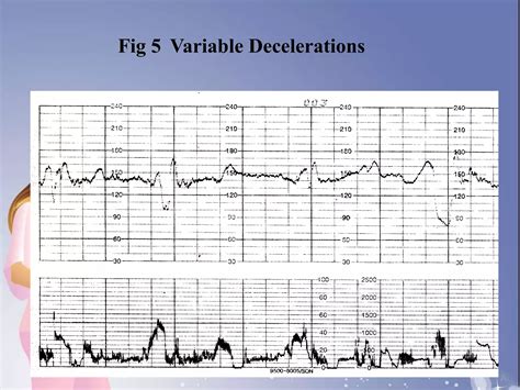 Efm Electerical Fetal Monitoring Legal Issues Problems Facts Define Indication Basic