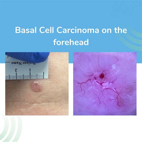 Nodular Bcc On The Forehead Kelowna Skin Cancer