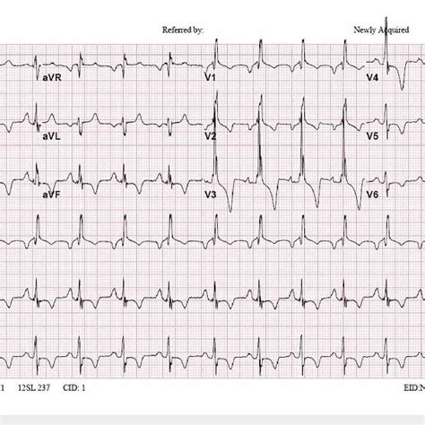 Patients Electrocardiogram Showing Right Bundle Branch Block And Right