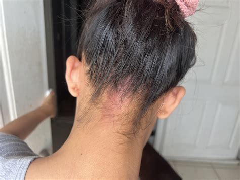 Scalp Rash R Scalppsoriasis