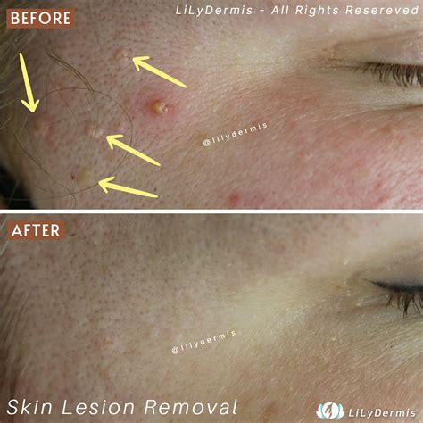 Sebaceous Hyperplasia Removal In Calgary Lilydermis