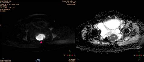 A Diffusion Weighted Images Show Restricted Diffusion In The Upper Download Scientific