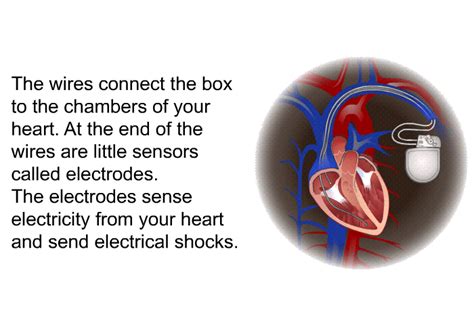 Implantable Cardioverter Defibrillator