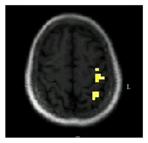 Longitudinal Observation Of Brain Activation In Case 4 During The