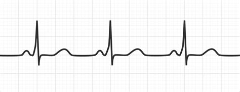 The PR Interval ECG Basics Medbabe