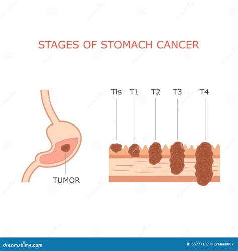 Stages Of Stomach Cancer Cartoon Vector 127279029