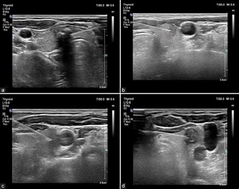 Diagnostic Value Of Ultrasound Guided Fine Needle Aspiration Cytology