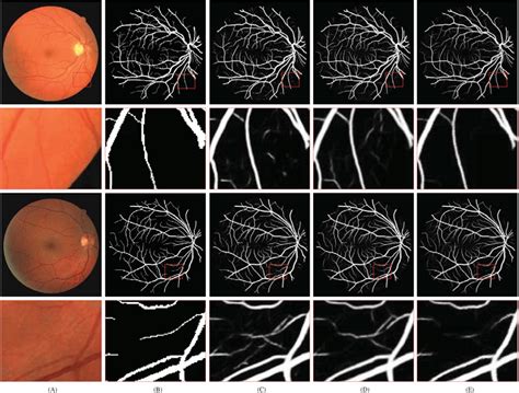 Examples Of Segmentation Results On Drive A Color Fundus Images B Download Scientific