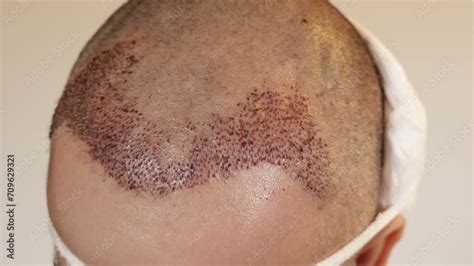The Top Of A Man S Head Right After A Hair Transplant By The FUE Method New 1500 Hairs Are