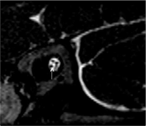White Arrow Shows Cochlear Nerve In Oblique Sagittal Reformatted Image Download Scientific