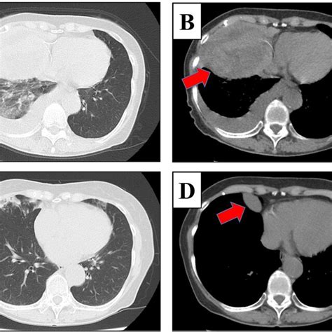 Computed Tomography Ct Shows A 9 Cm Mass Shadow In The Middle Lobe Of