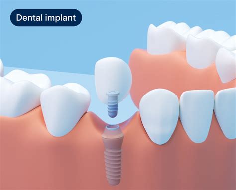 Root Canal Vs Dental Implant Which Is Right For You Aspen Dental