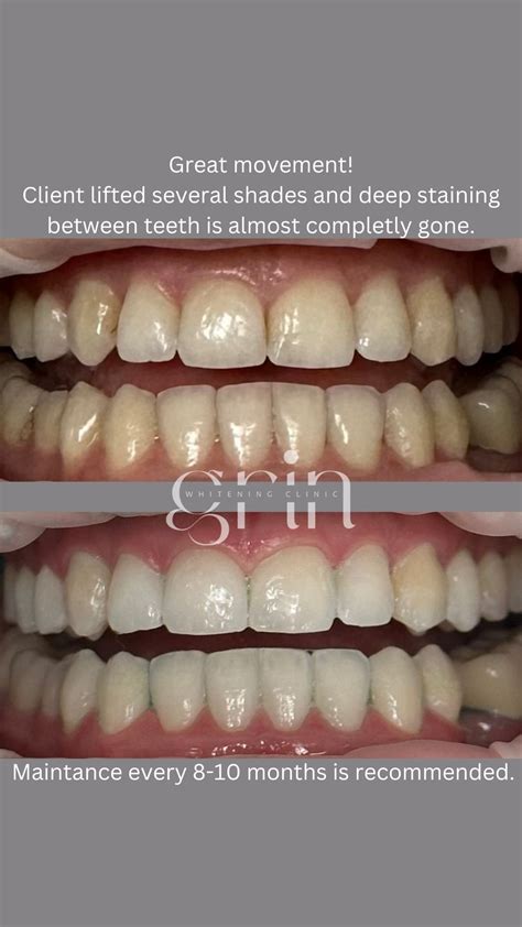 Before And After Grin Whitening Clinic