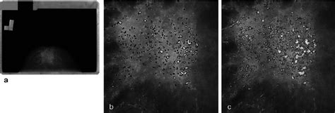 A Mammogram R21tif From Bezanijska Kosa And Segmented