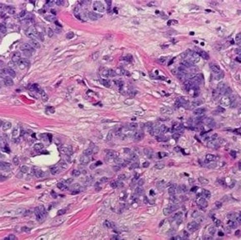 Bach Breast Cancer Histology Images Kaggle