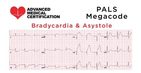 Pals Megacode Bradycardia And Asystole