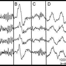 PDF Case Comparison Of Sleep Features From Ear EEG And Scalp EEG