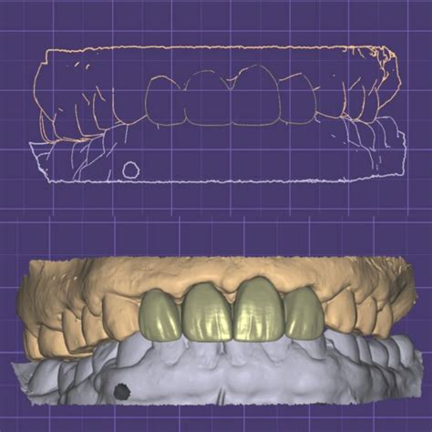 Exocad Design Yahya Salman