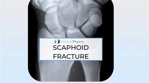 Scaphoid Fractures Clinical Physio Membership