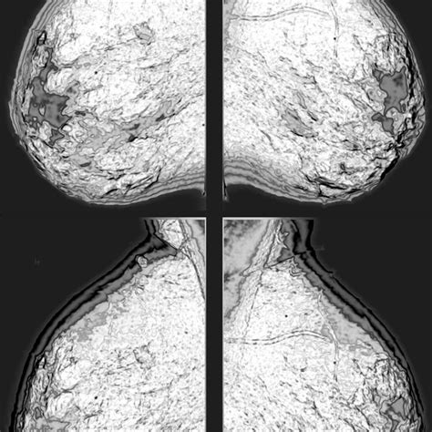 The Log Likelihood Image Of The Original Mammogram From Fig1 In The