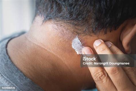 Darkskinned Asian Men Apply Skin Treatment Suffer From Scalp Dermatitis