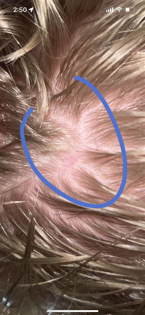 Folliculitis Rfolliculitis